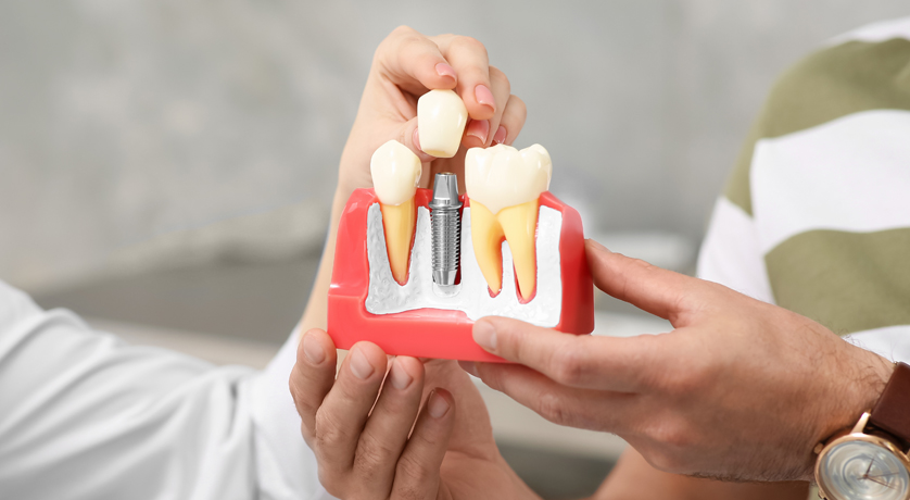 Dental Implants in Hamilton, ON | Dental Implants Near You